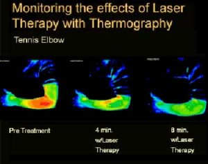 Laser Therapy – Midwest Pain Treatment Center